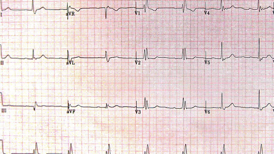 ECG Interpretation: The Basics of 12-lead ECGs